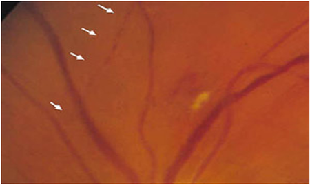 انسداد الشريان الشبكي المركزي - موسوعة العلوم العربية